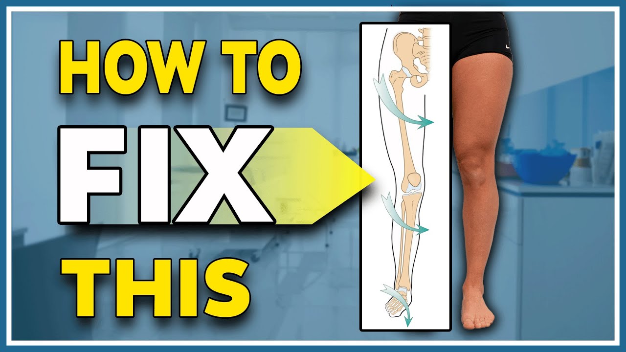 The most overlooked cause of knee pain - Patellar endotorsion - YouTube