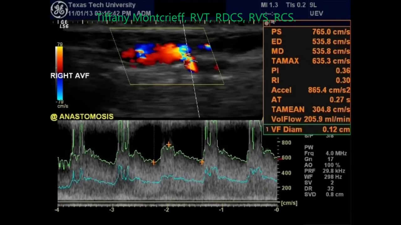 Radial/cephalic Arterio/venous Fistula Duplex Evaluation AVF - YouTube