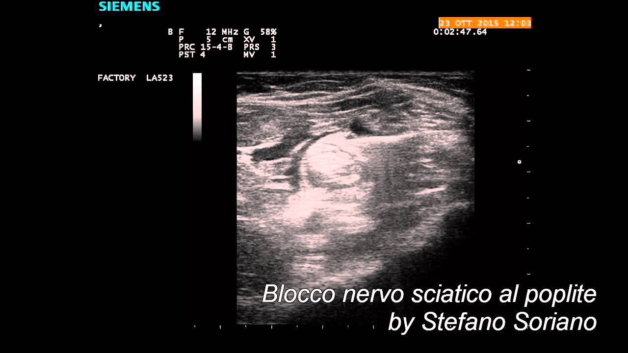 Blocco nervo sciatico al poplite con tecnica ecoguidata (Popliteal ...