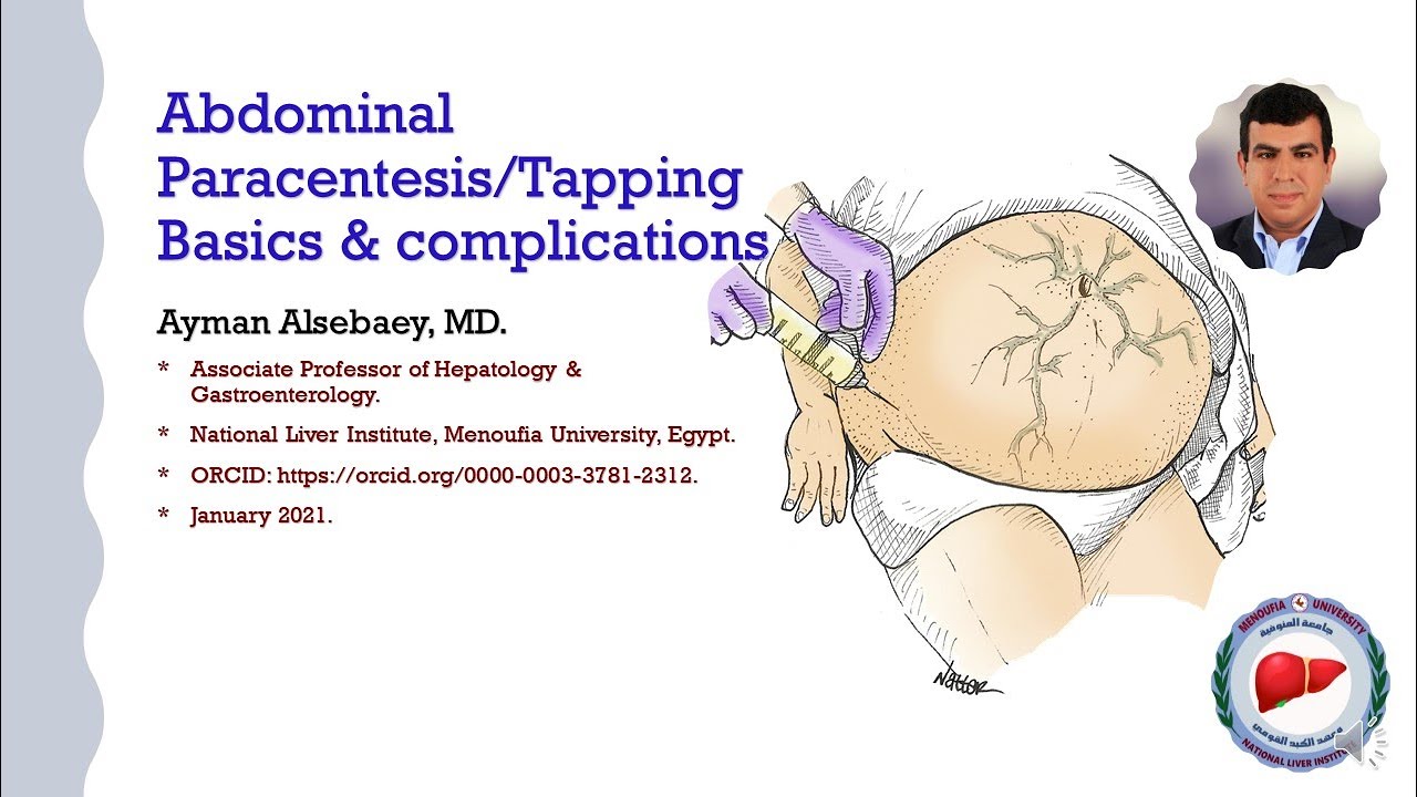 Abdominal ParacentesisT apping Basics & complications. - YouTube