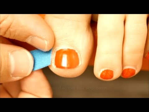 Podo-Taping-Concept© Nagelfalz Tape, eingewachsener Zehen - Nagel ...