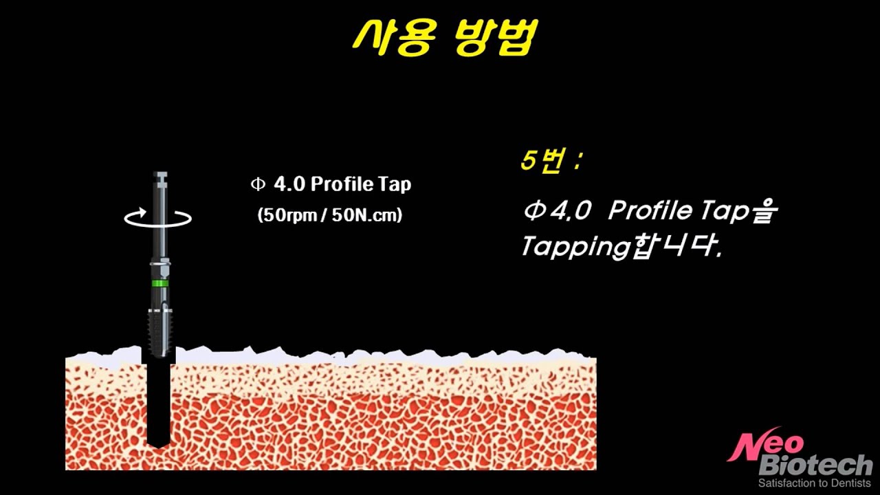 NeoBiotech Bone Planer(Full Ver.) - YouTube
