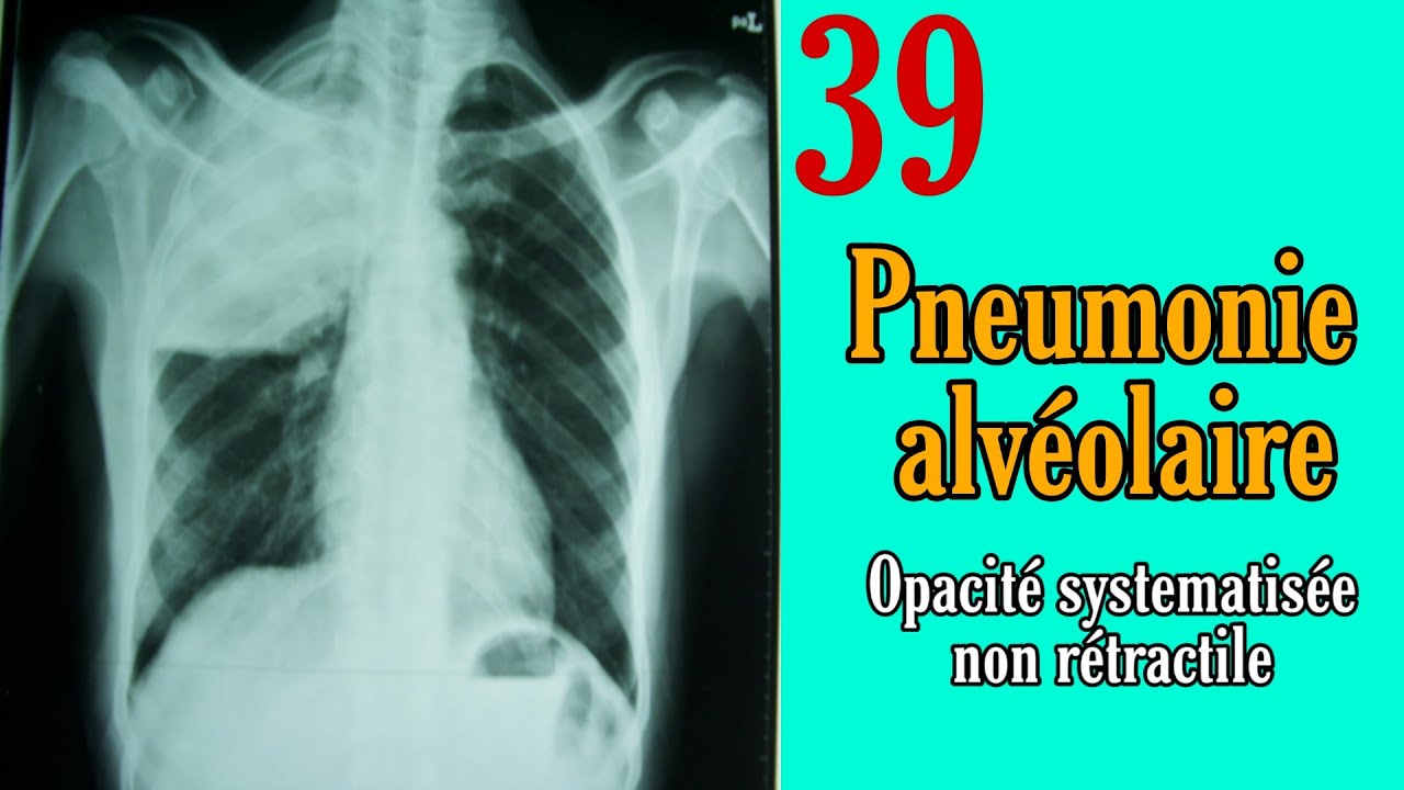 Telethorax : Pneumonie alvéolaire (Opacité systématisée non retractile ...