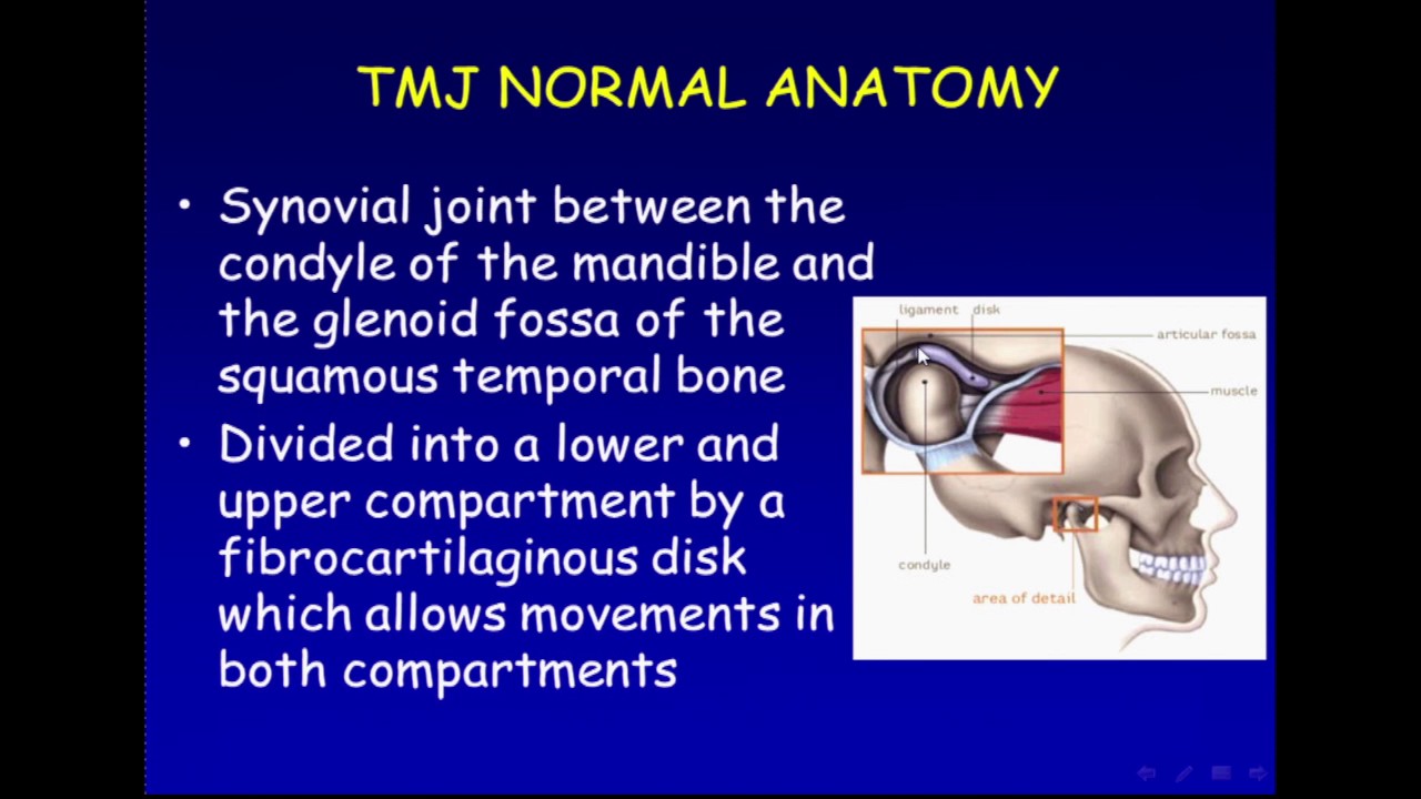 Temporomandibular Disk Displacement US and MRI - YouTube