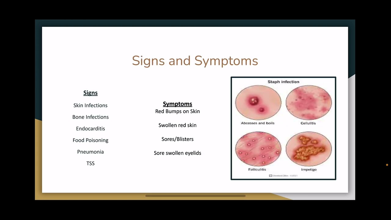 Staph infection presentation - YouTube
