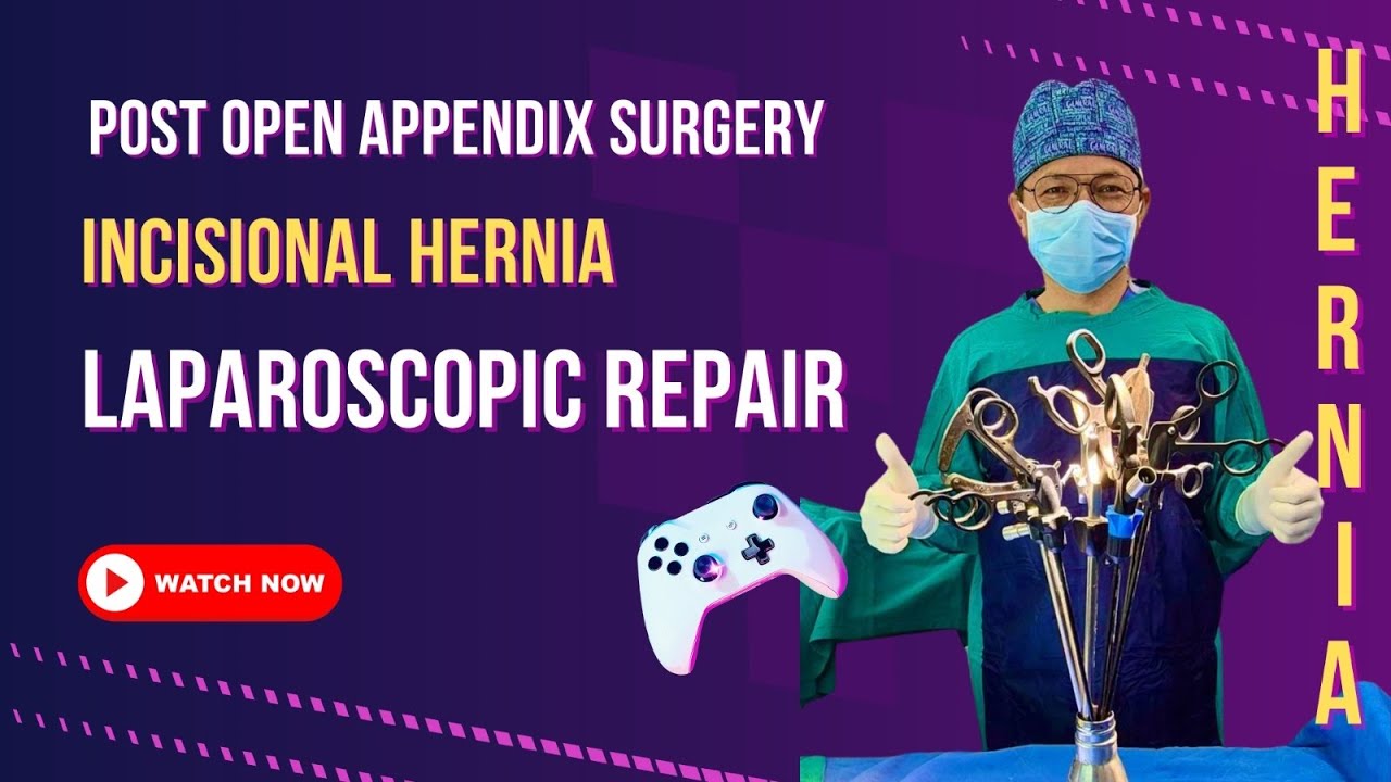 Keyhole repair of post appendix open surgery incisional hernia - YouTube