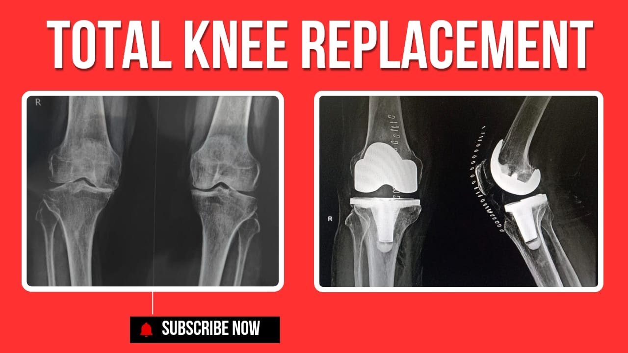 TOTAL KNEE REPLACEMENT WITH ZIMMER LPS IN A 64/M USING SUB VASTUS ...