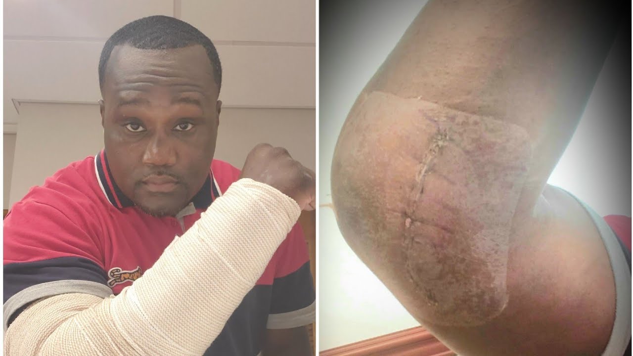 Ulnar Nerve Entrapment Surgery Result!!! ##ulnar #surgery - YouTube