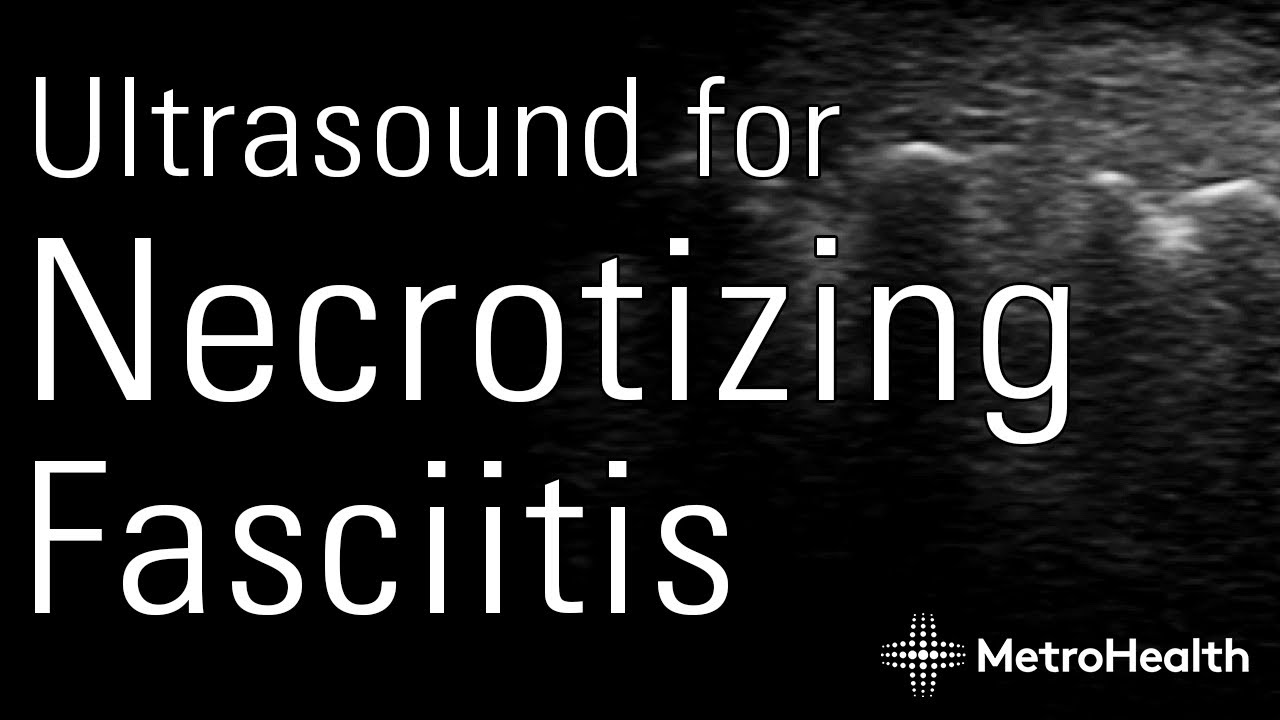 Ultrasound for Necrotizing Fasciitis - YouTube
