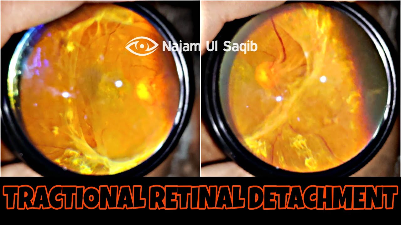 Tractional Retinal Detachment (TRD) In Advanced Diabetic Eye Disease ...