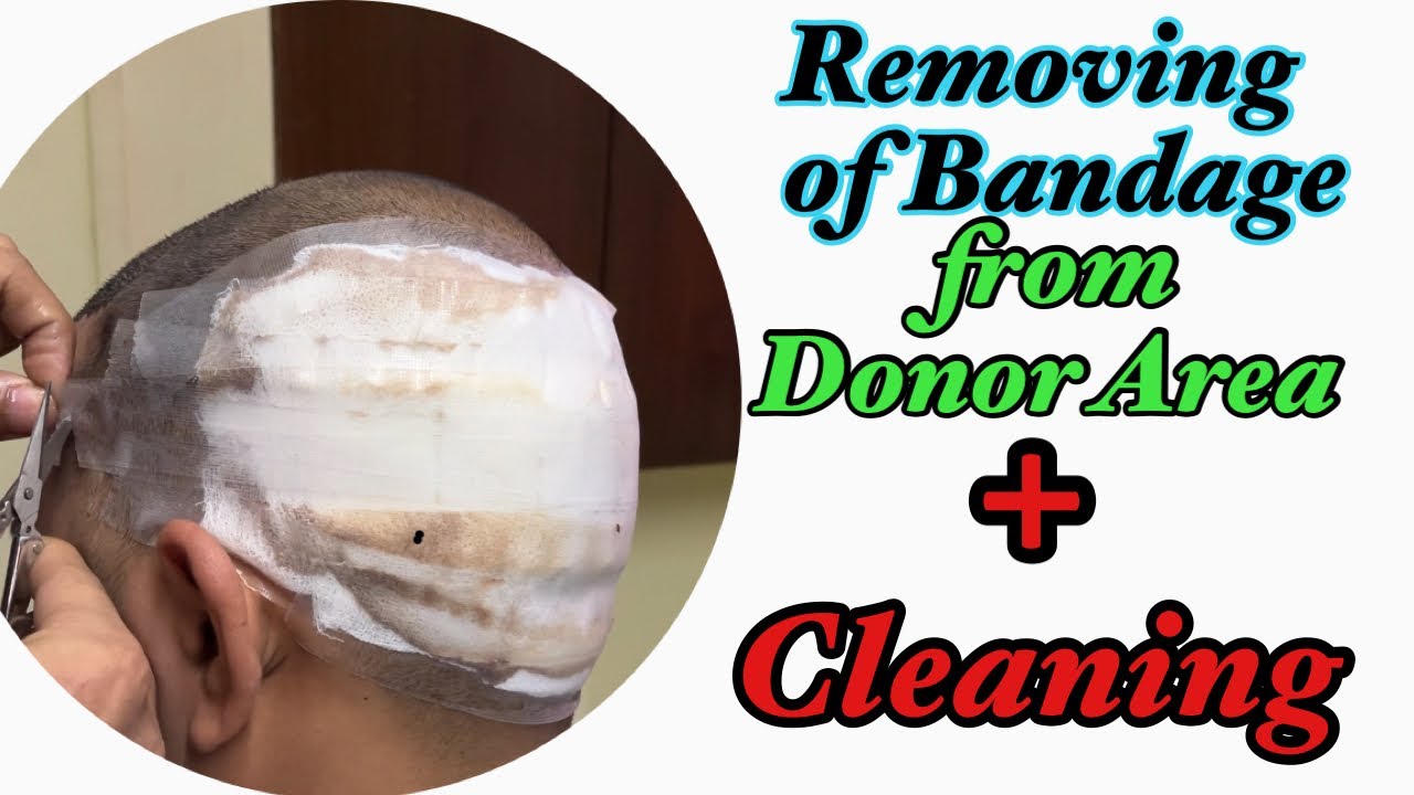 Bandage removal after hair transplant / bandage kaise nikale hair ...