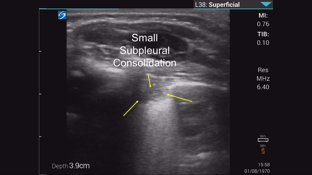Infant with Bronchiolitis on Lung Ultrasound - YouTube