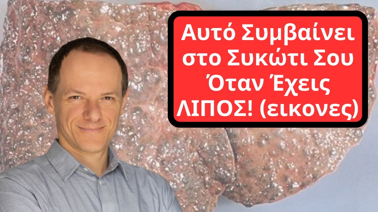 Τι Κάνει το Λίπος στο Συκώτι στο Σώμα Σου – Με Εικόνες! - YouTube