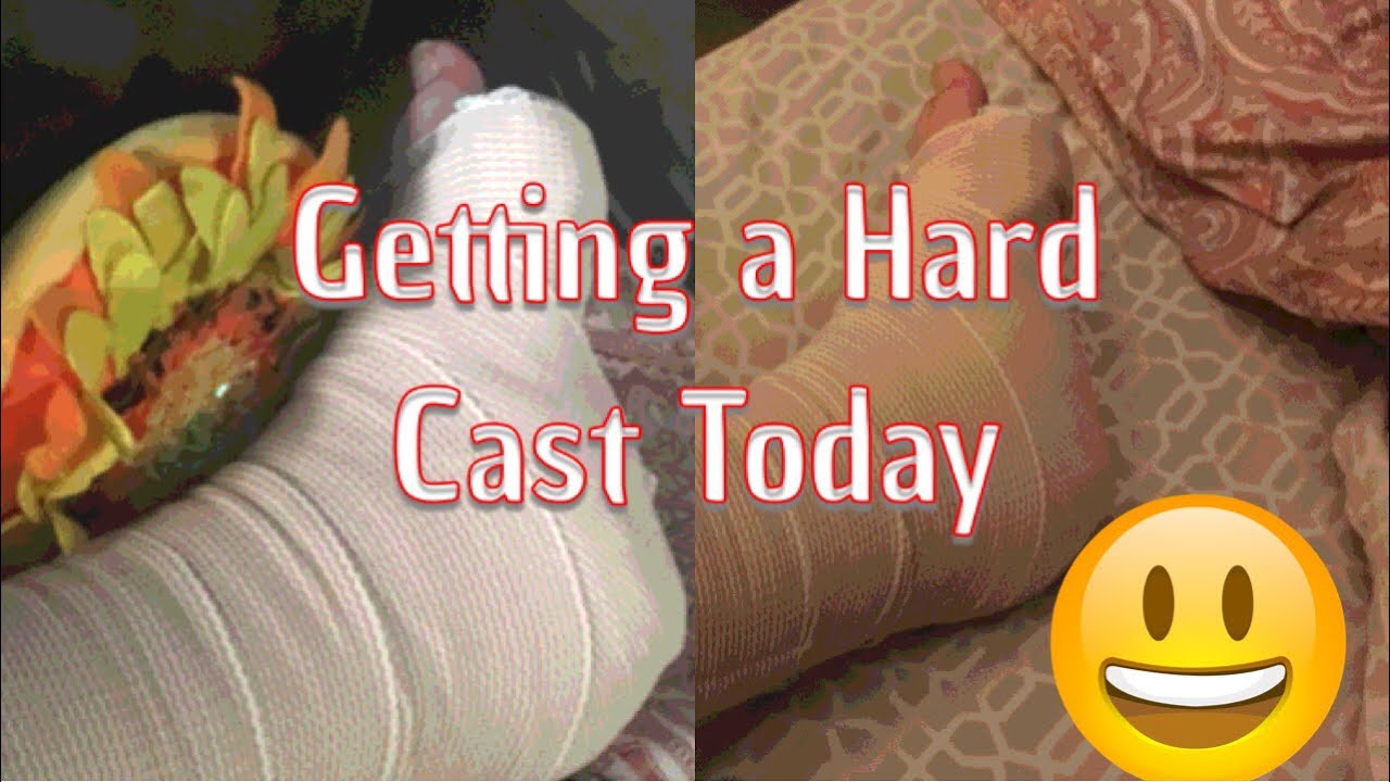 Getting A Hard Cast Today Update With A Broken Ankle Week 2 - YouTube