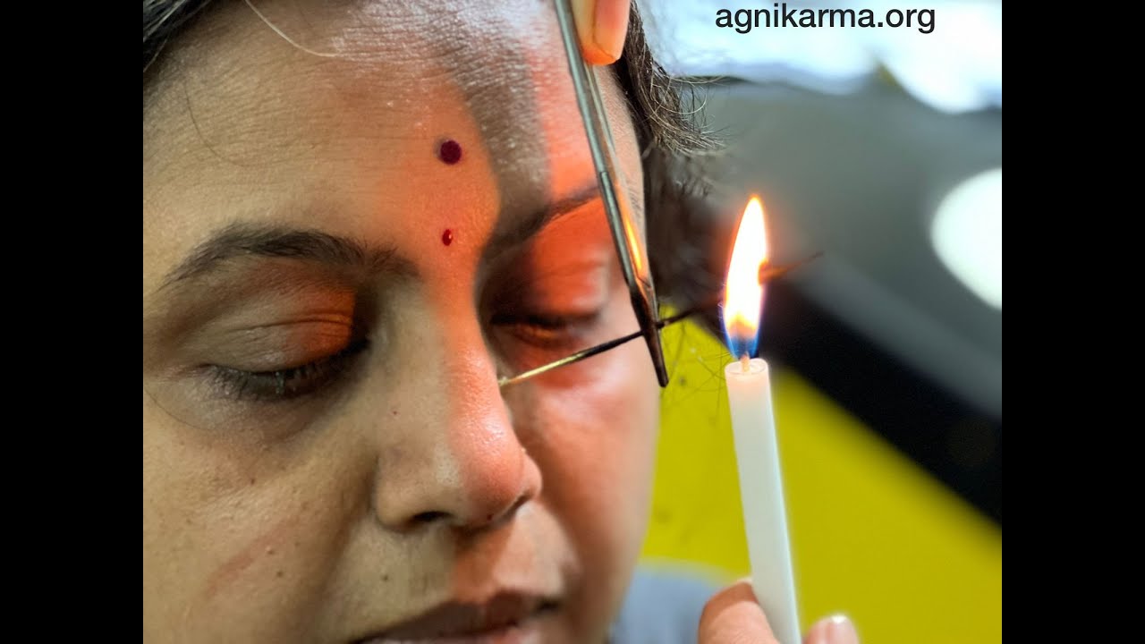 Viddhakarma & Agnikarma in ENT by Dr chandrakumar deshmukh - YouTube