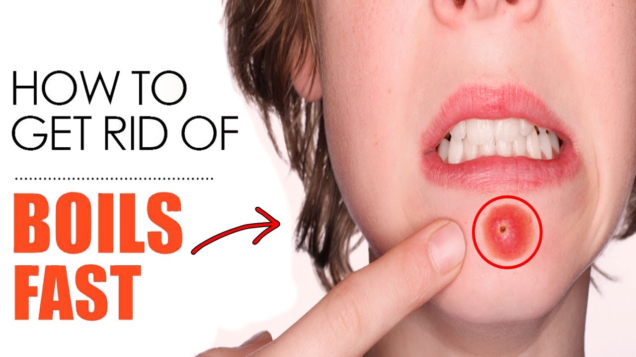 How to Get Rid of Boils Naturally || Home Remedies for Boils Treatment ...