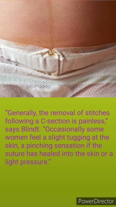 Is removing C-section stitches painful? - YouTube