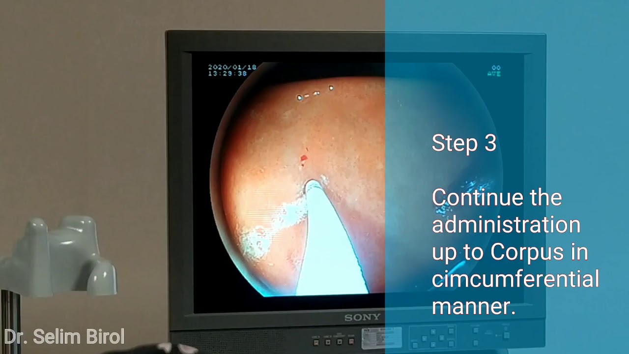 Technic of Safe and Effective Gastric Botox (Stomach Botox) for weight ...