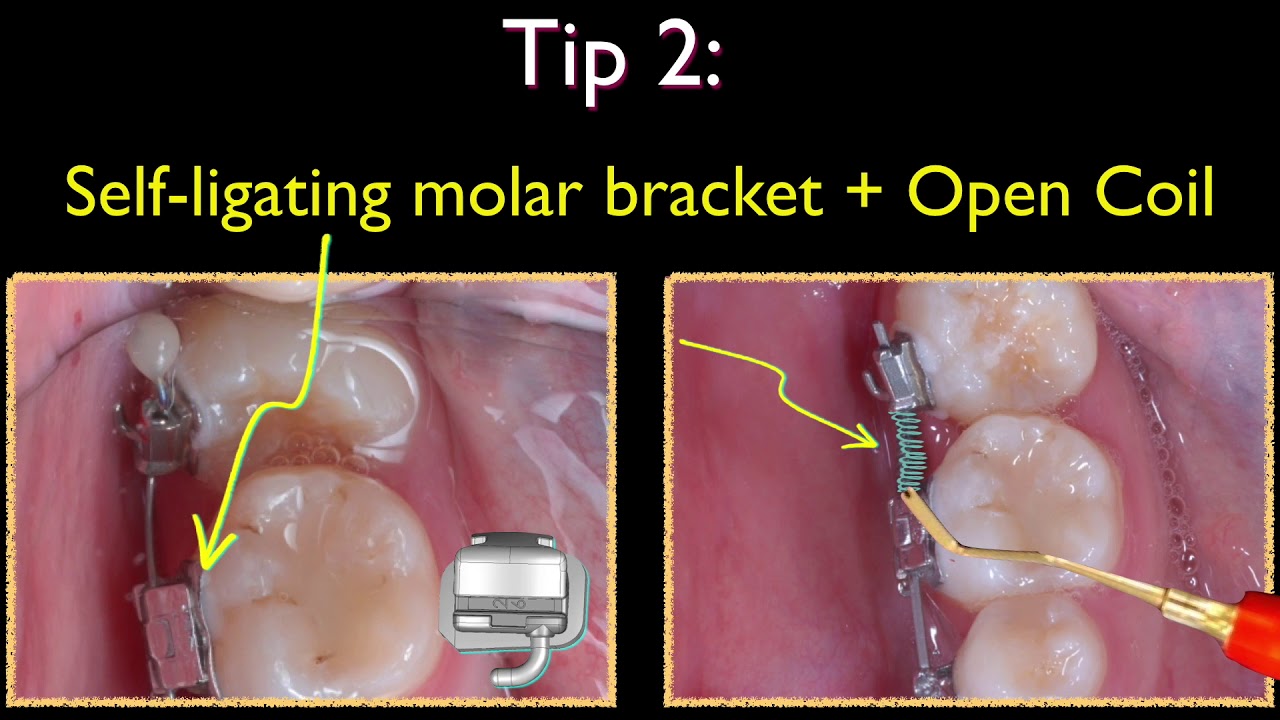 2018 AAO Innovative Impaction Treatment Part 2 （live）｜【Chris Chang ...