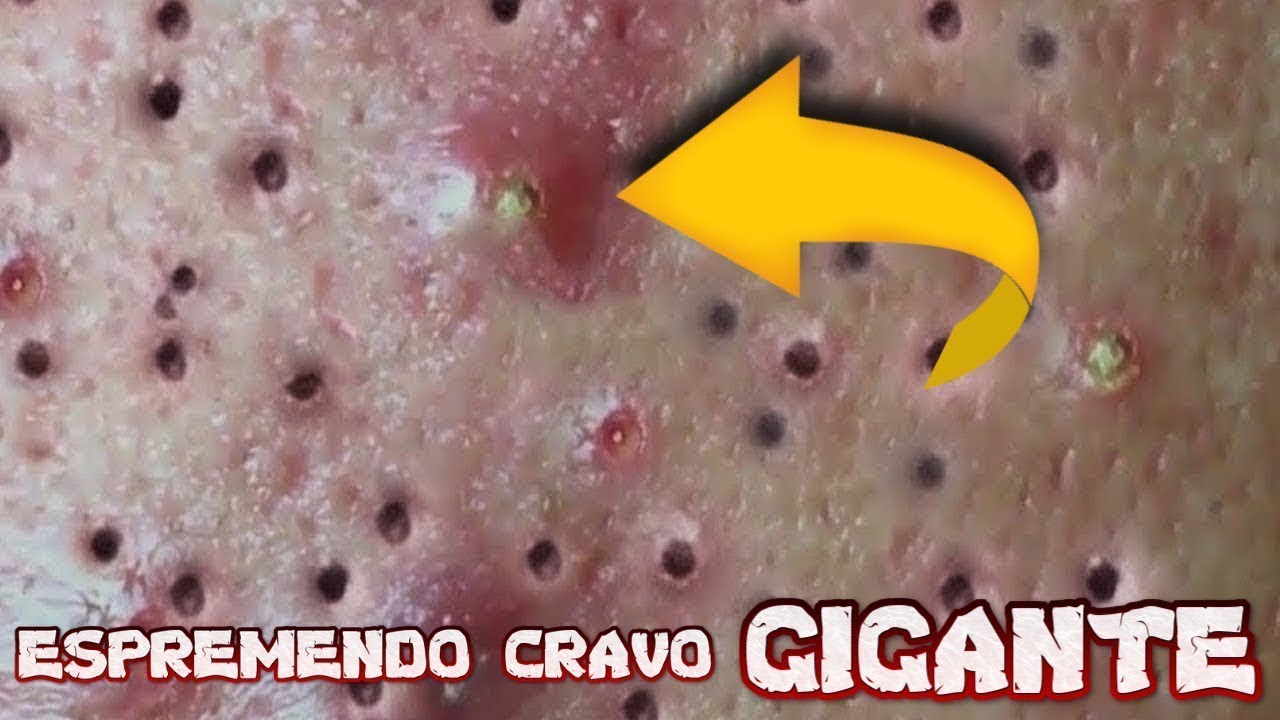 espremendo cravos pretos 😬 - YouTube