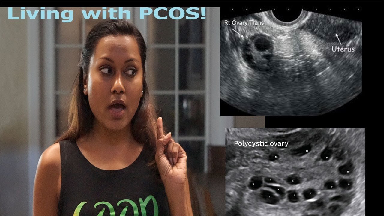 PCOS diagnosis and how I treat my symptoms. - YouTube