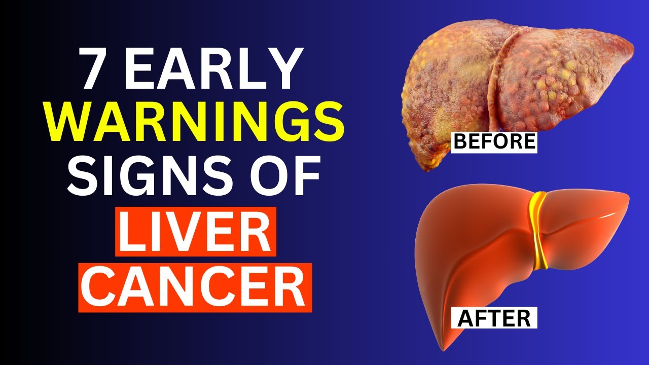7 Early Warning Signs of Liver Cancer: What You Need to Know to Save ...