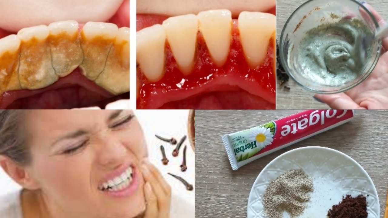 The magic mixture for teeth whitening and tartar removal, getting rid ...