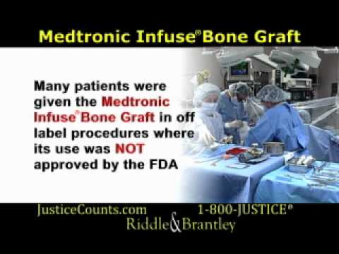 Medtronic Infuse® Bone Graft - YouTube
