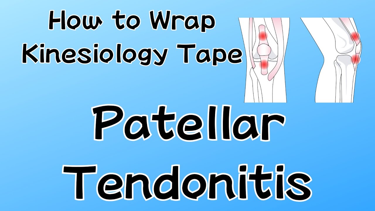 Patellar ligamentitis taping #taping #kinesiotaping # ...