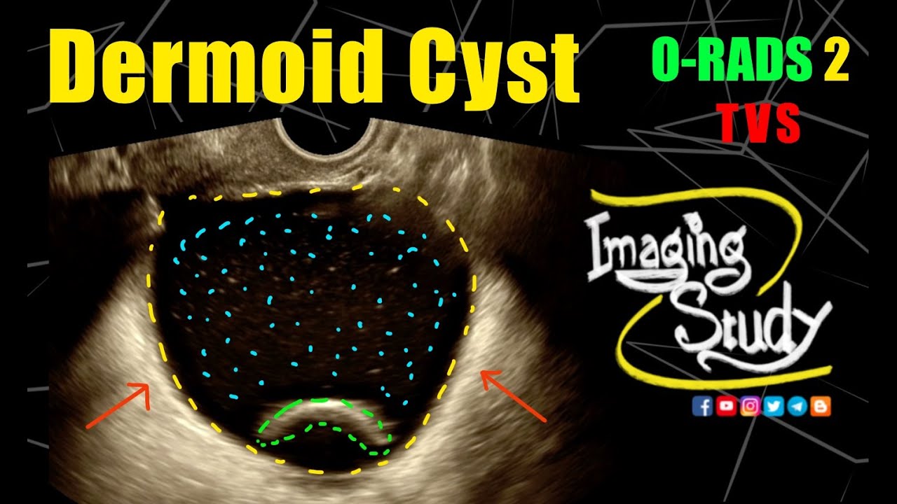 Adnexal Dermoid Cyst | Mature Cystic Teratoma | ORADS 2 || Ultrasound ...