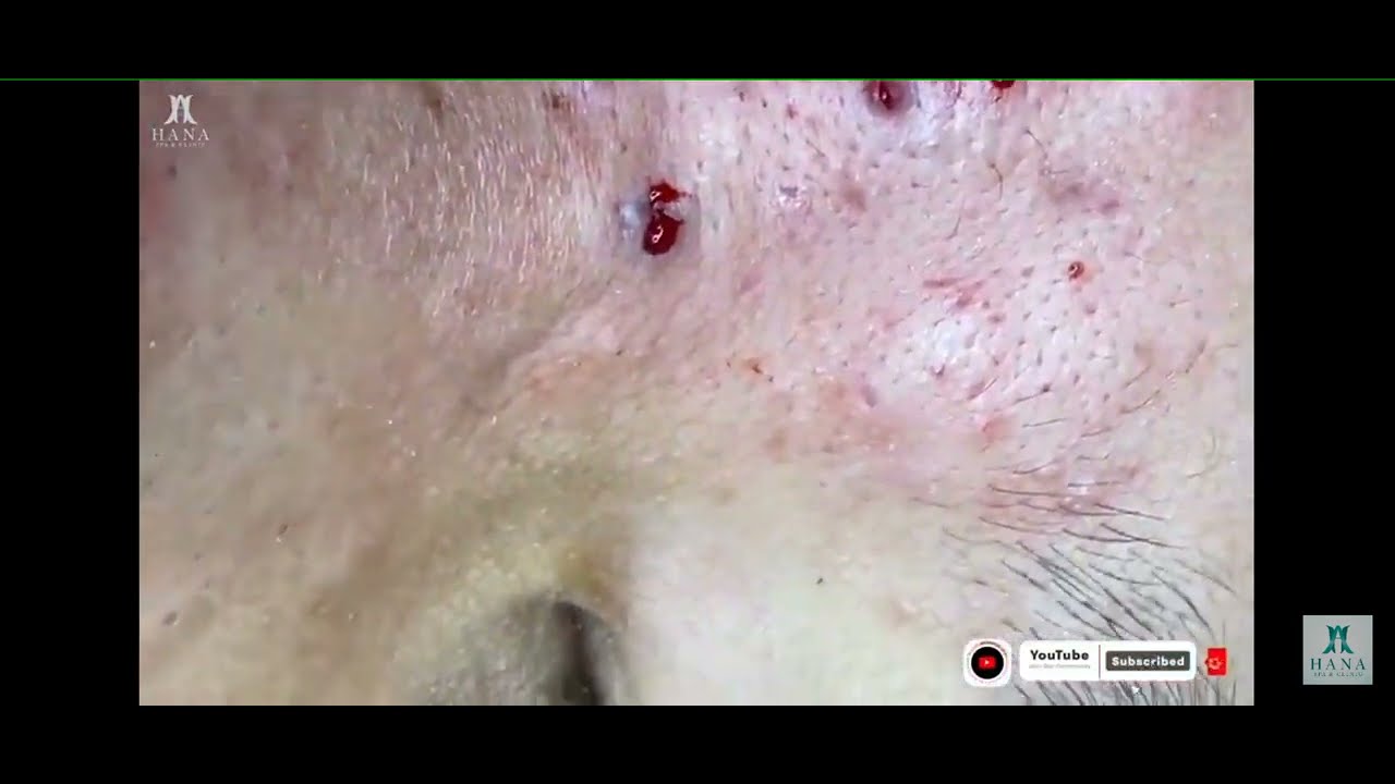 how to remove blackheads from nose removal | how to remove Blackheads ...