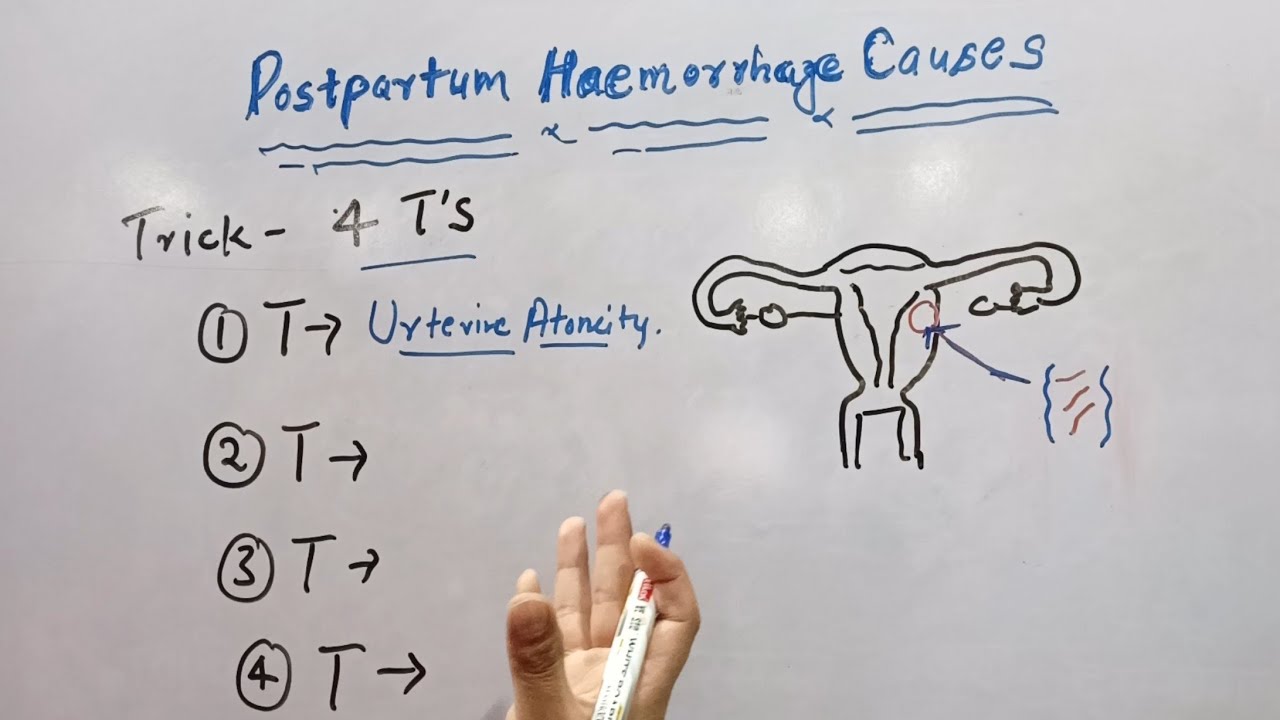 Postpartum Hemorrhage Cause Tricks Mnemonic l #bams #aiapget # ...