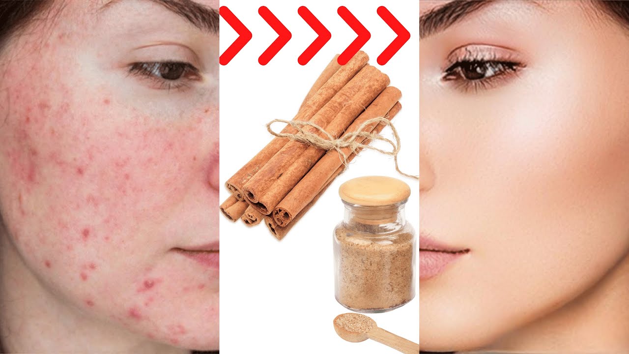 how to remove pimples overnight | acne treatment | remove acne pimples ...