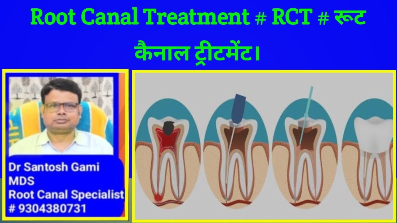 Root Canal Treatment # RCT # रूट कैनाल ट्रीटमेंट। - YouTube