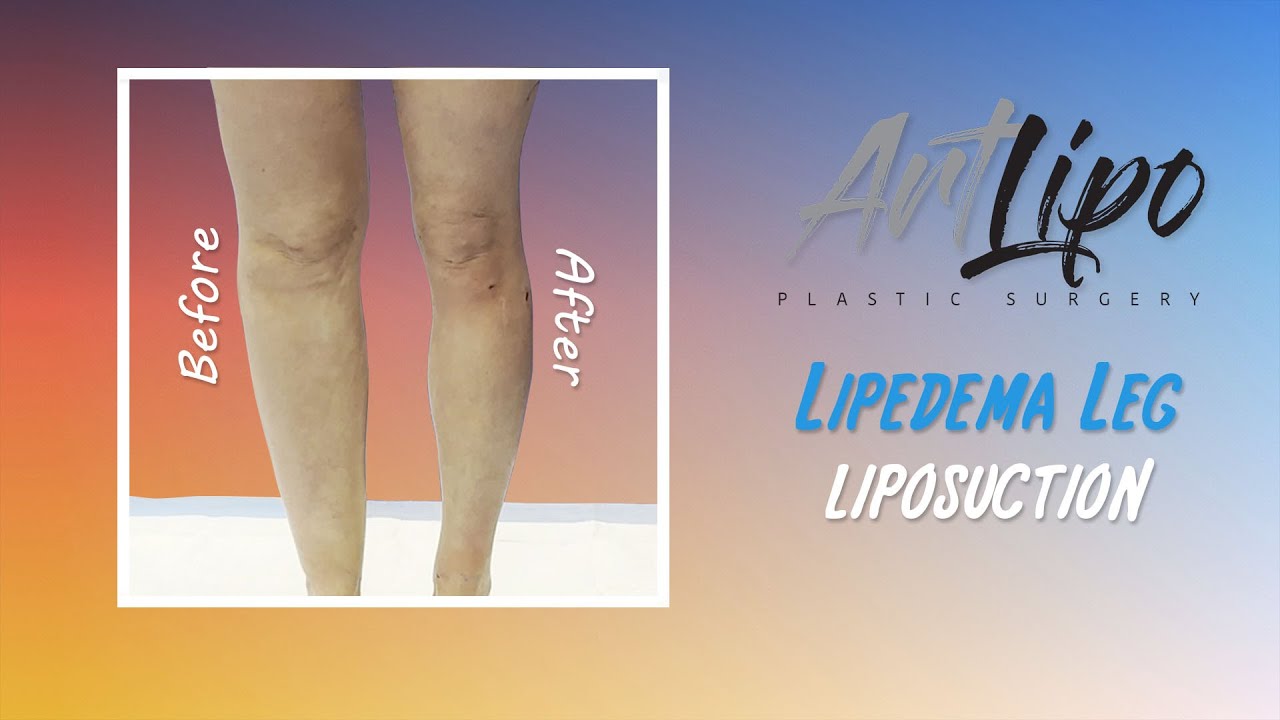 Lipedema Liposuction Surgery | Legs | Immediate Results | Cankles ...