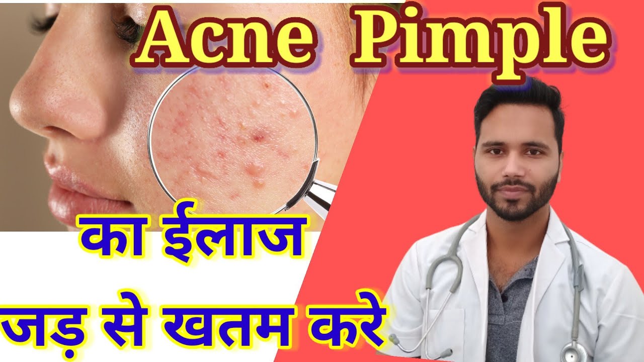 acne treatment | pimple removal |chehre ke pimple kese hataye | pimple ...