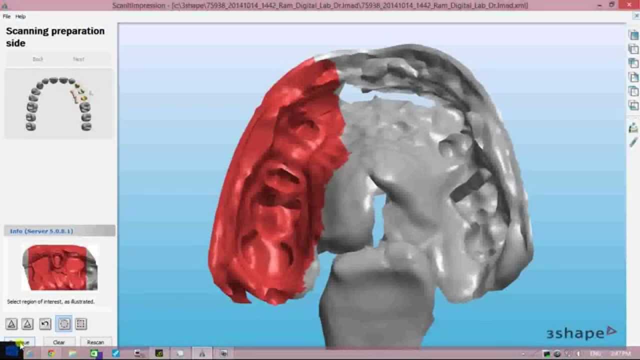 Impression Scanning in 3Shape (Single Tray with no Antagonist) - YouTube