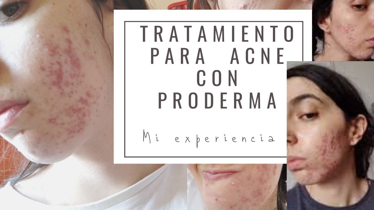 Mi experiencia con PRODERMA ( tratamiento acné ) - YouTube