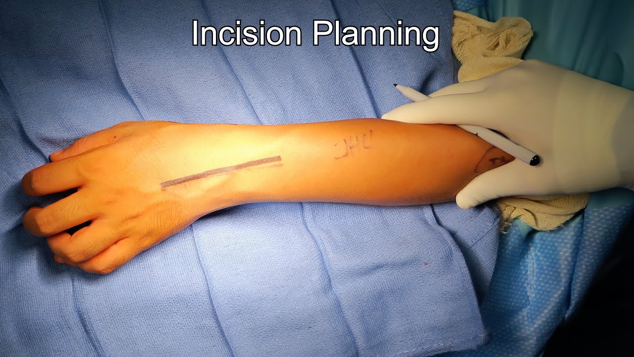 Lunate Reconstruction with Medial Femoral Trochlea Microvascular Free ...