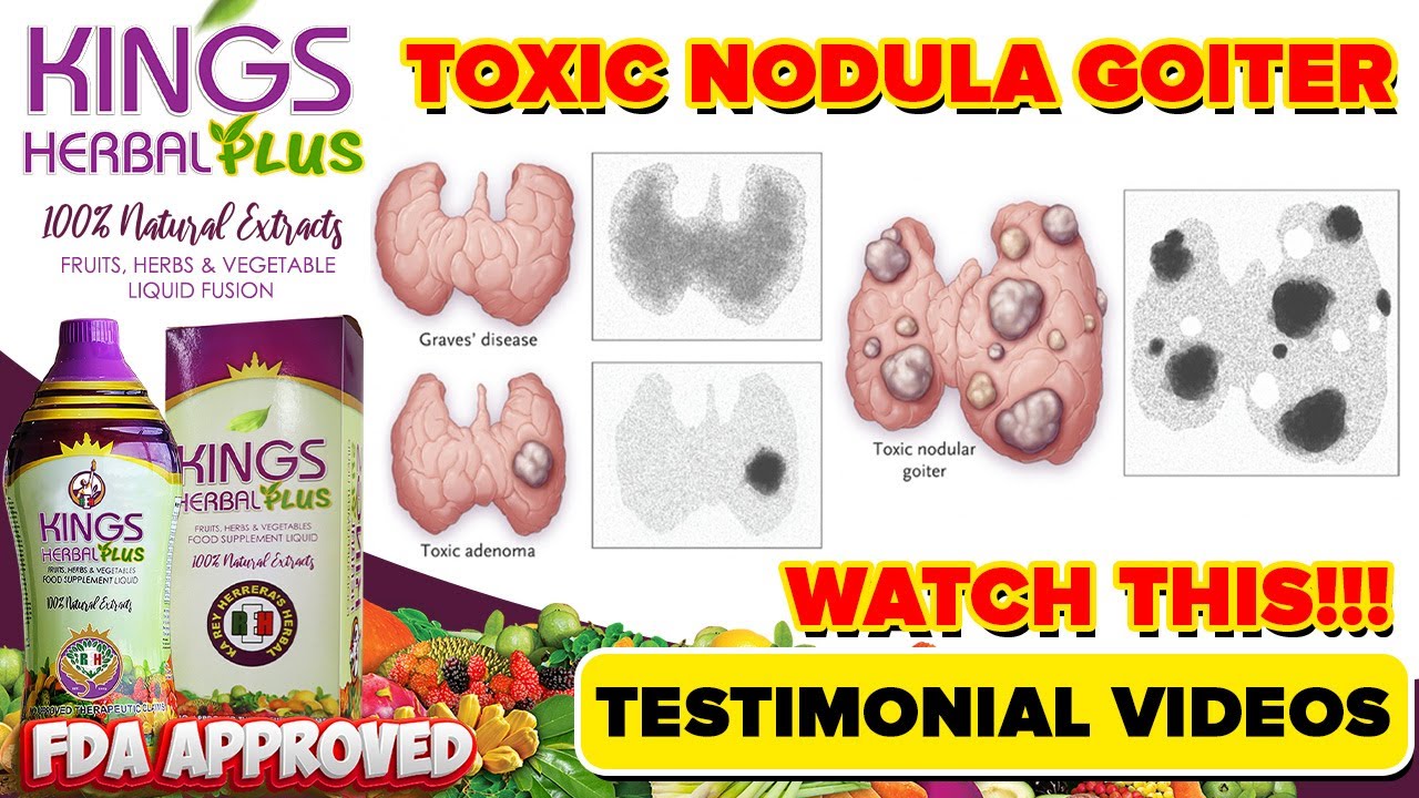 Toxic Nodular Goiter - KINGS Herbal Plus Testimonial Video - YouTube