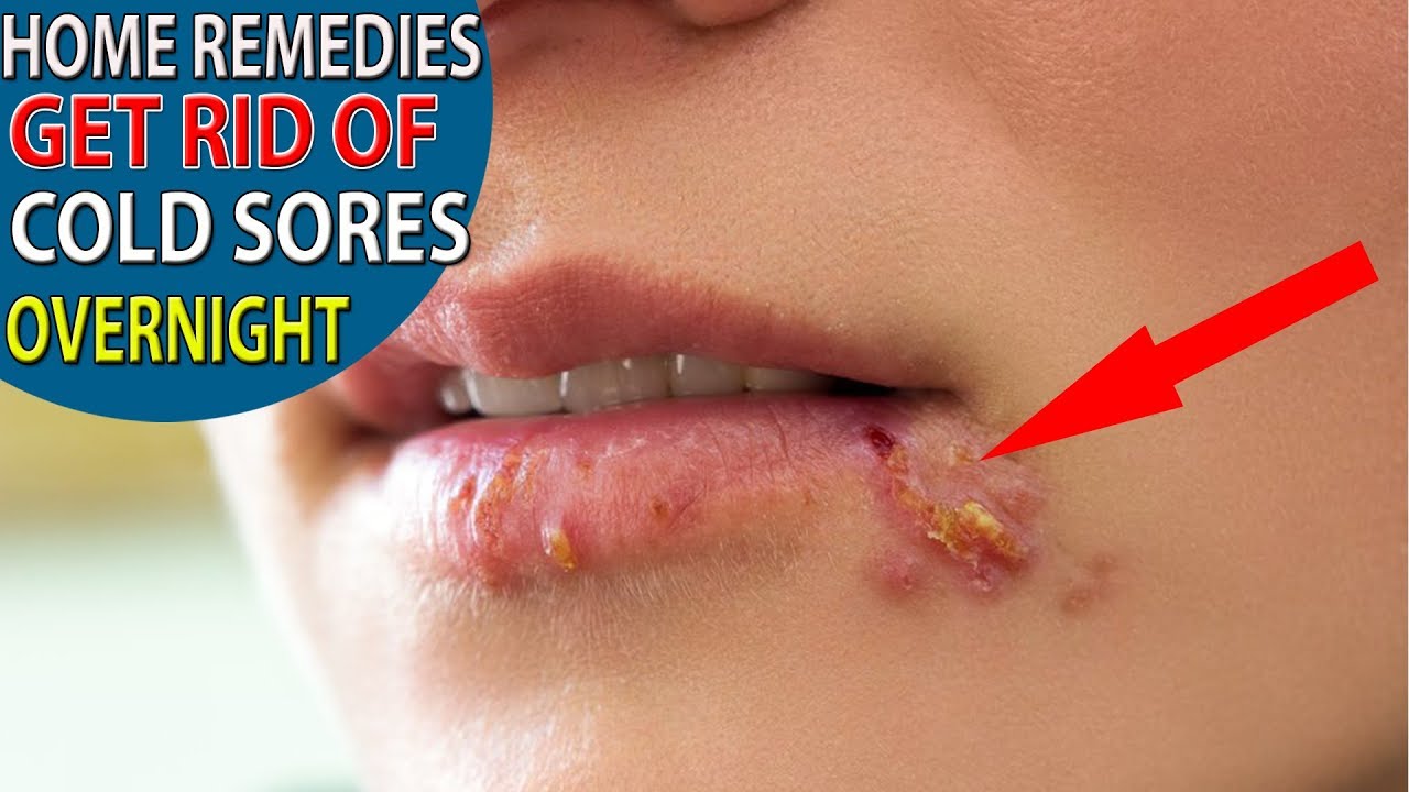Cold Sores -How to Get Rid of A Cold Sore Quickly Overnight|Health ...