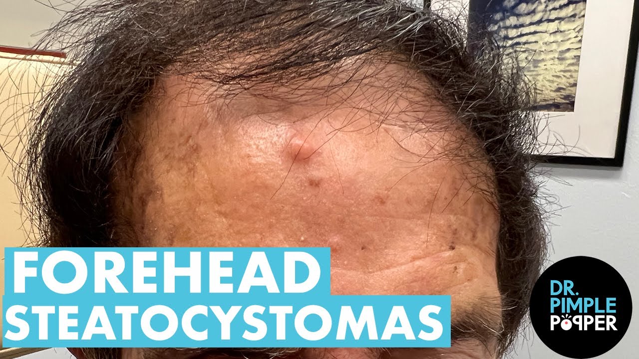 WHAT IS ON YOUR FOREHEAD? Dr Pimple Popper Extracts Steatocystomas ...