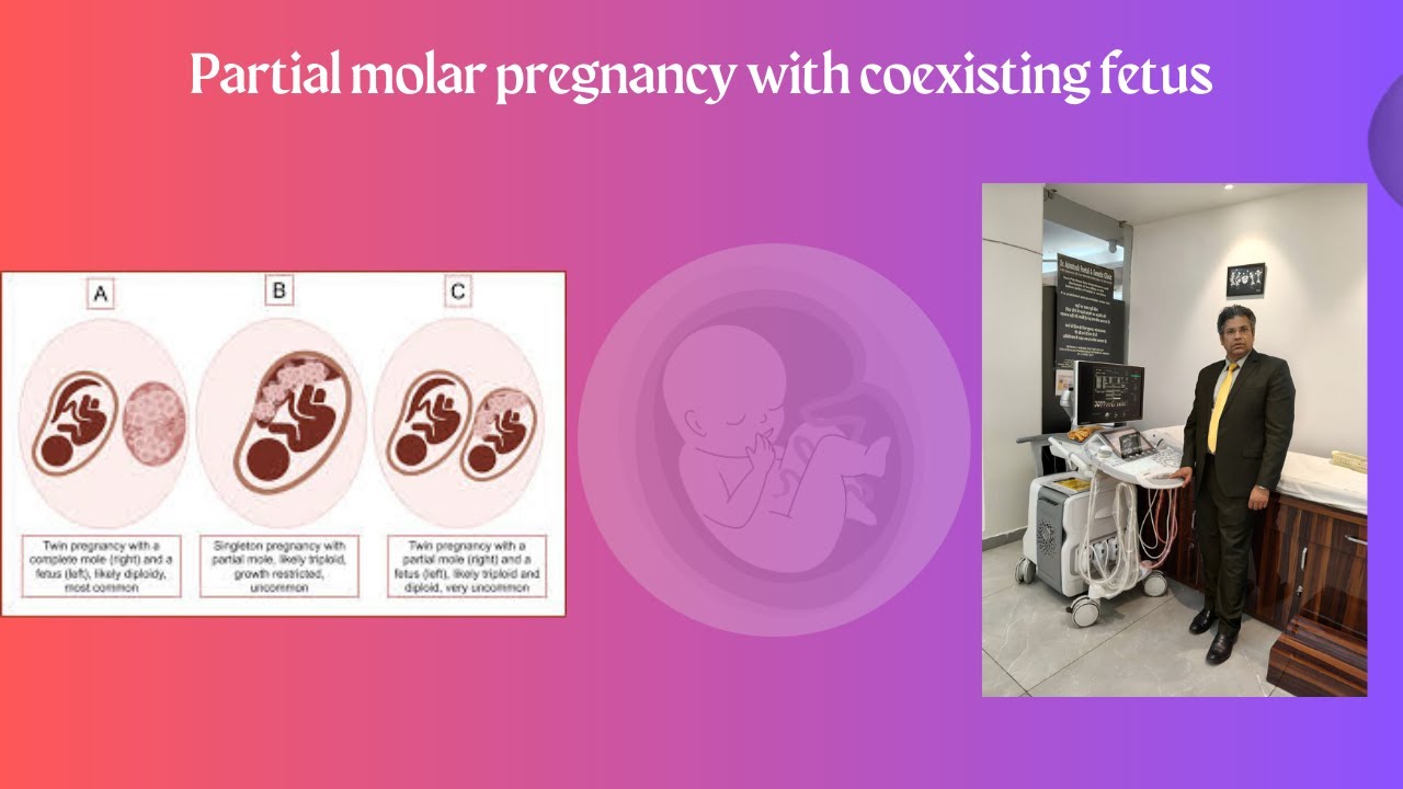 Partial molar pregnancy with coexisting fetus - YouTube