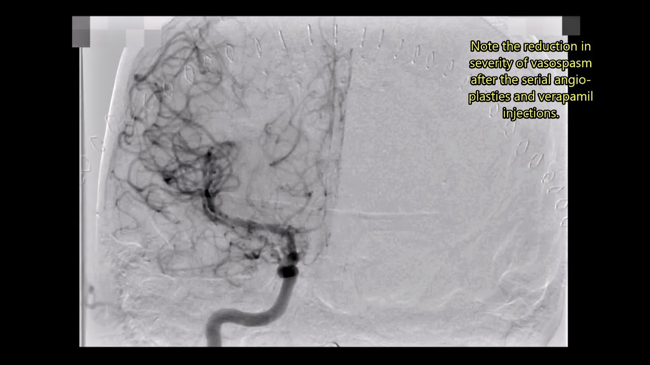 Primary Angioplasty for Treatment of Cerebral Vasospasm Secondary to ...