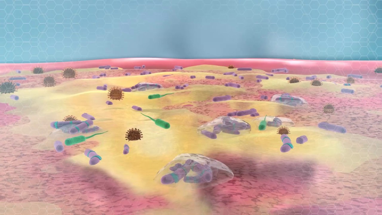 UCS Debridement - The Unique, convenient, safe solution for wound ...
