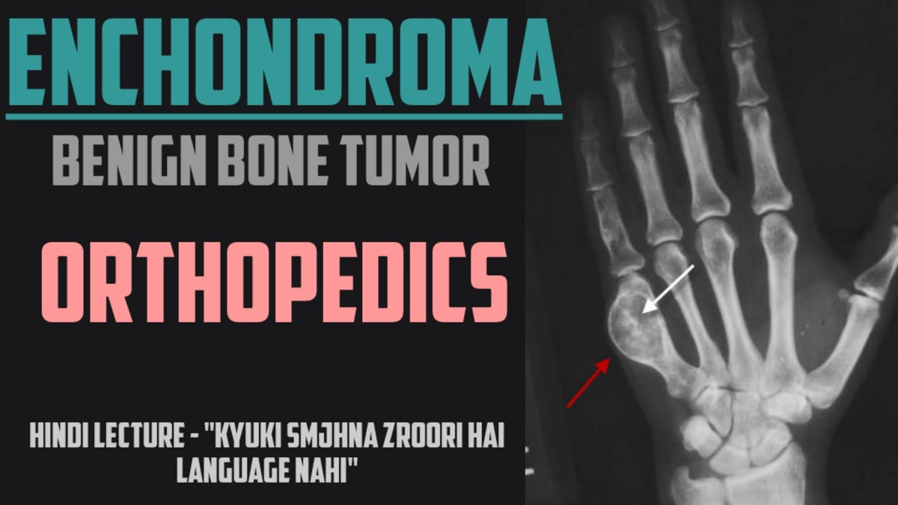 Enchondroma || Benign Bone Tumor || Orthopedics 9 || NEET PG - YouTube