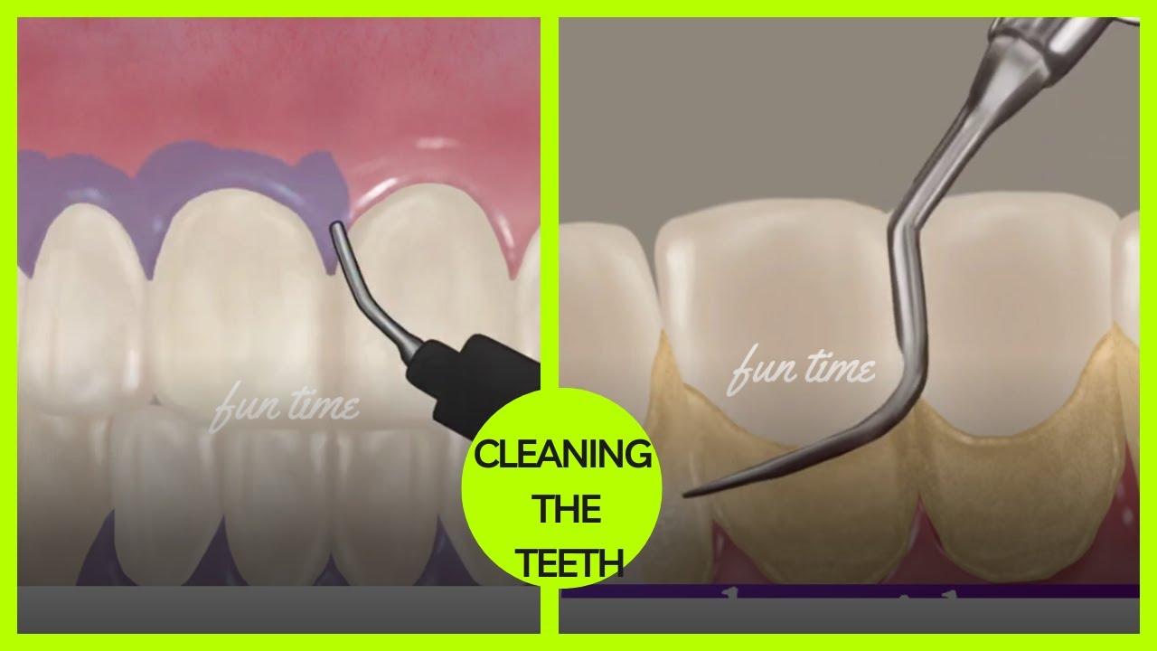 Keep Tooth Decay Away: Medical Treatments and Cleaning Tips/TOOTH DECAY ...