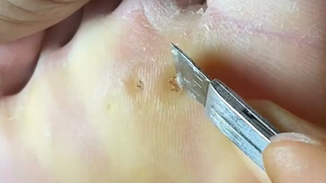 Vanquish a pair of the Devil's eyes【Athlete’s foot pedicure】 - YouTube