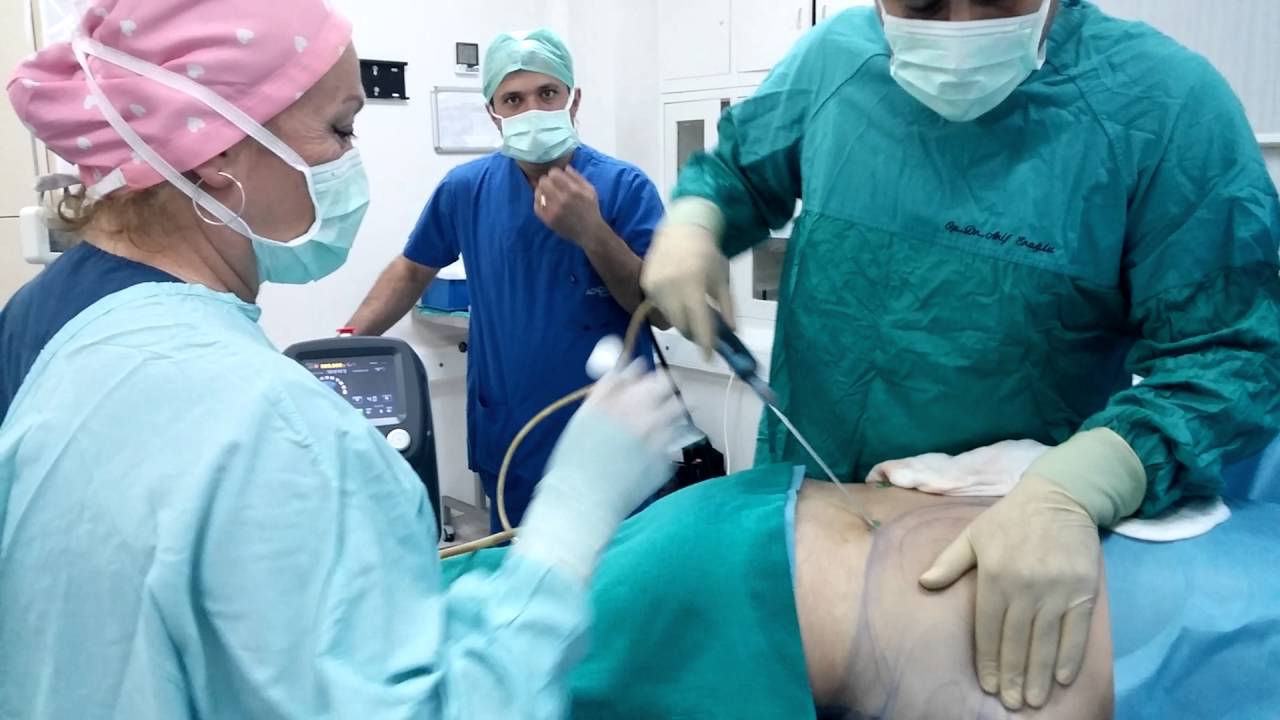 Liposuction Procedure 3 PAL - YouTube
