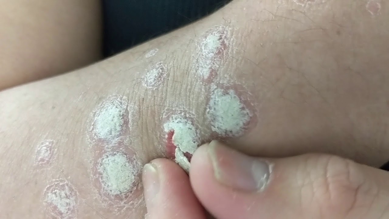 BARNACLES?! [Psoriasis] - YouTube